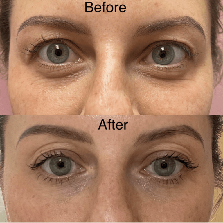 NeoGen – PSR - Renew You MedSpa & IV Bar