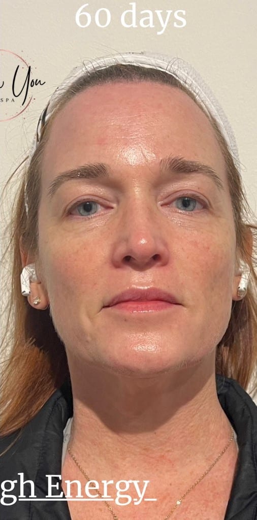 NeoGen PSR Archives - Renew You MedSpa & IV Bar