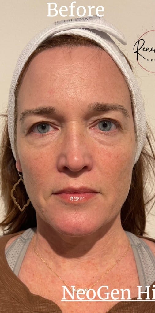 NeoGen PSR Archives - Renew You MedSpa & IV Bar