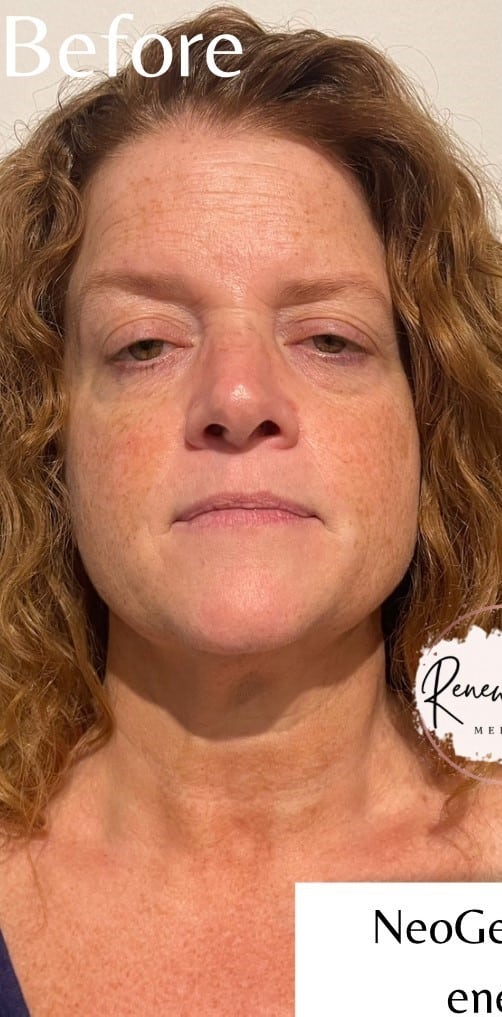 NeoGen PSR Archives - Renew You MedSpa & IV Bar